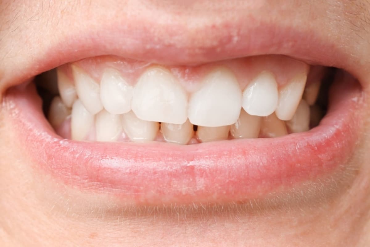 Open Bite: Causes, Treatment Options & Types Explained