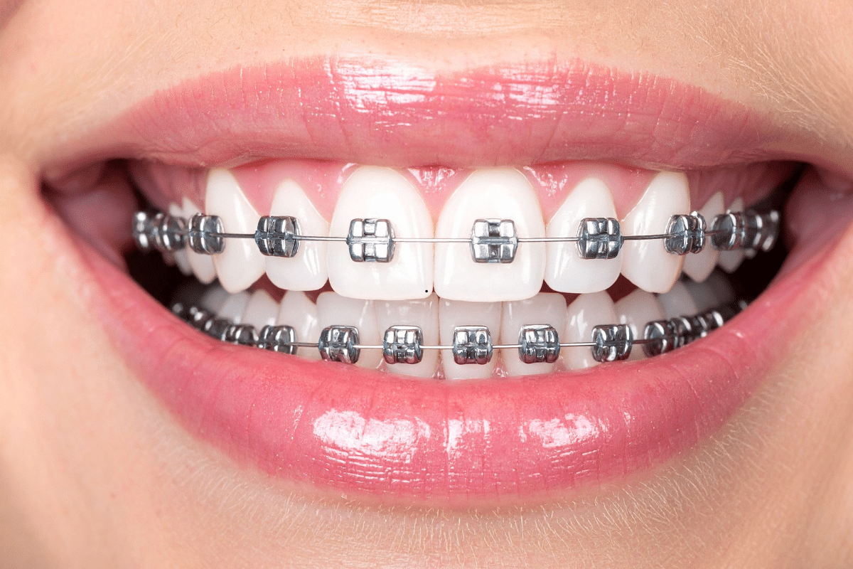 Swallowed Braces? Don't Panic! Here's What To Do